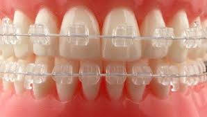 Sistema de Ortodoncia con Braquets Estéticos - Clínica Dental Alicante