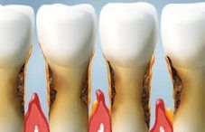¿Qué es una Caries Radicular? - Clínica Dental Alicante
