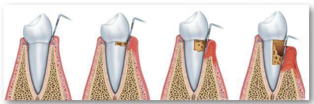 ¿Qué es una Caries Radicular? - Clínica Dental Alicante